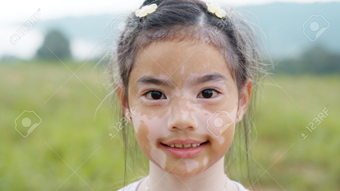 Little Cute Alpha Young Albino Vitiligo Small School Girl Relax Smile ...